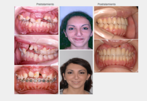 Dentición Permanente – Clinica Martin Romero